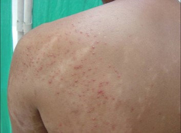 Tests for Skin Mets – Say YES to HOPE